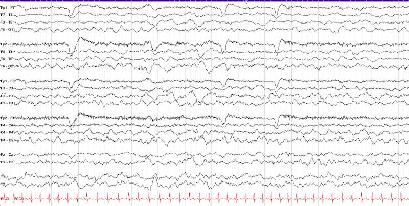 The Pediatric EEG